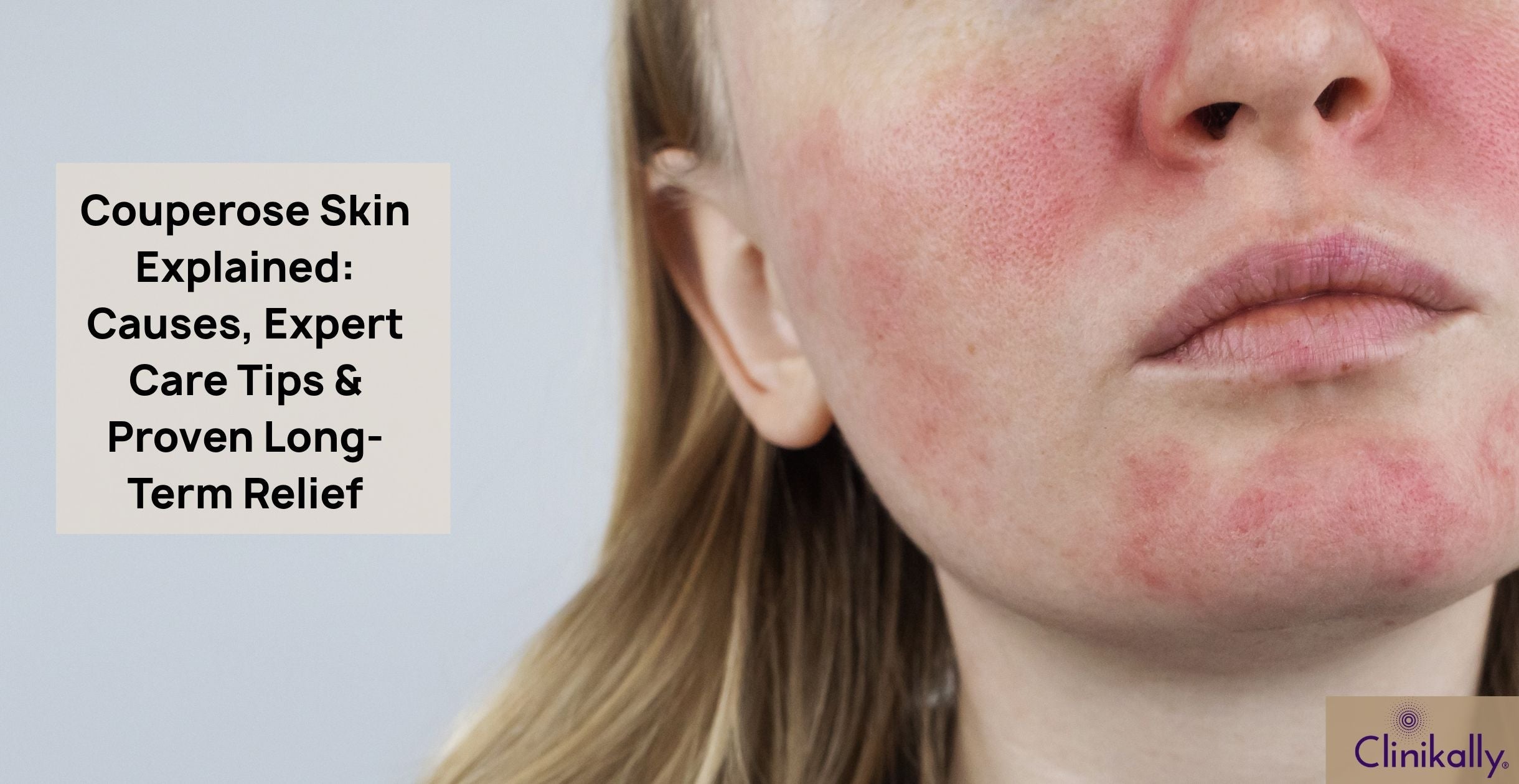 Couperose Skin: Causes, Treatment and Expert Tips for Care