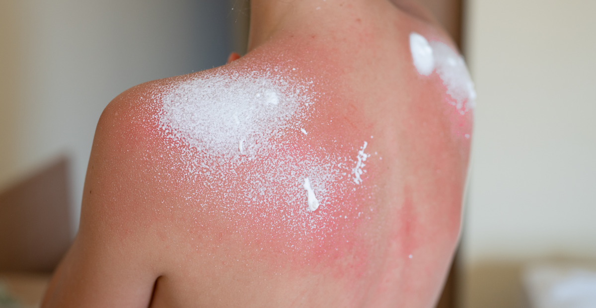 Sunburn vs. Sun Poisoning (Doctor's Guide) | Clinikally