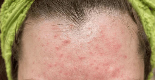 Malassezia Biofilm: What It Is and How to Treat It | Clinikally