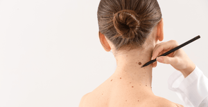 Understanding the Difference Between Beauty Marks and Mole | Clinikally