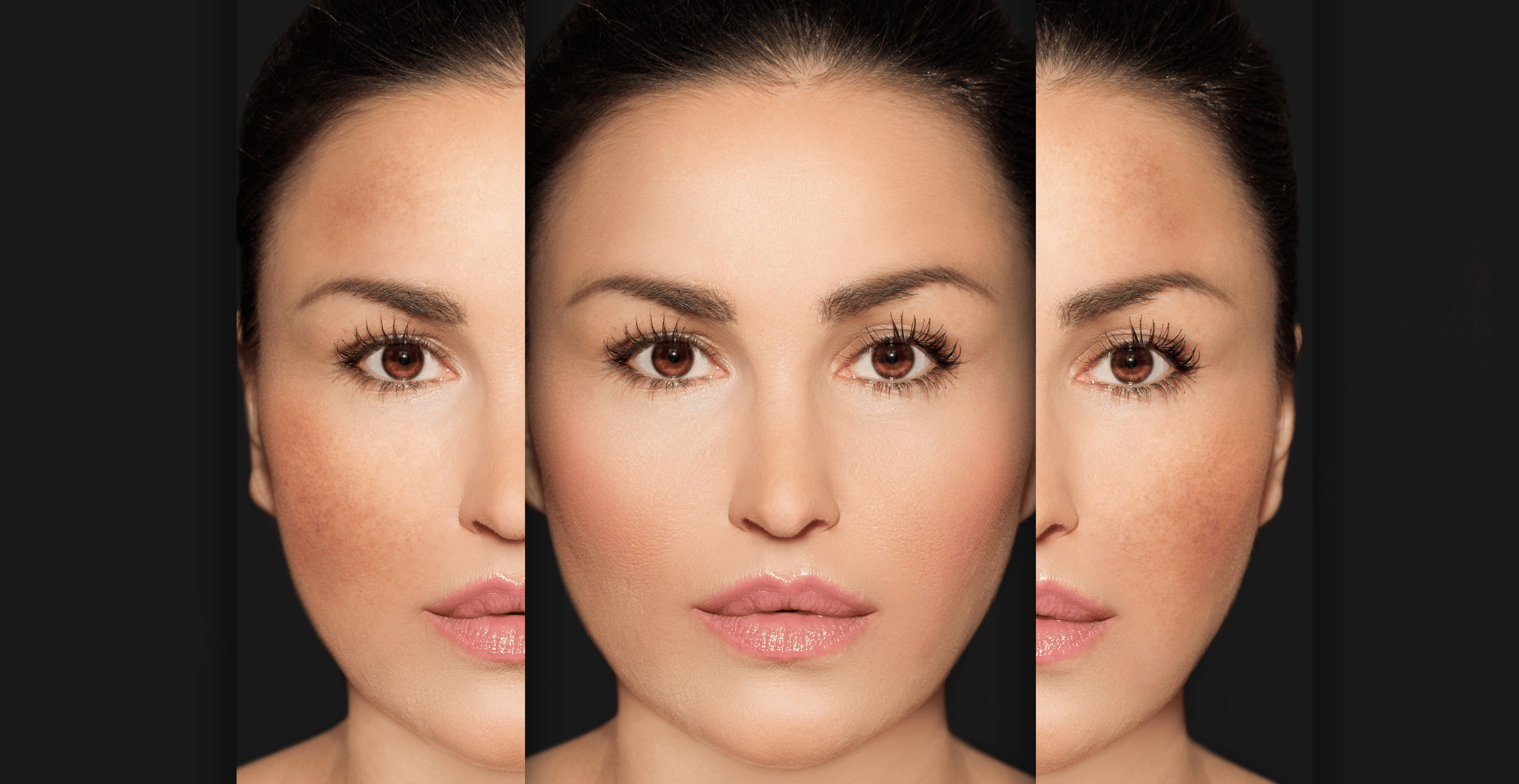 Understanding Sun Spots: Causes, Effects, and Treatment | Clinikally