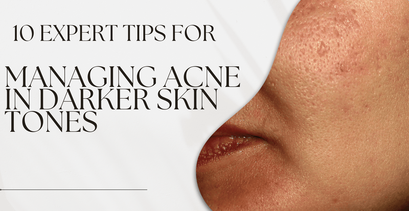 10 Expert Tips for Managing Acne in Darker Skin Tones