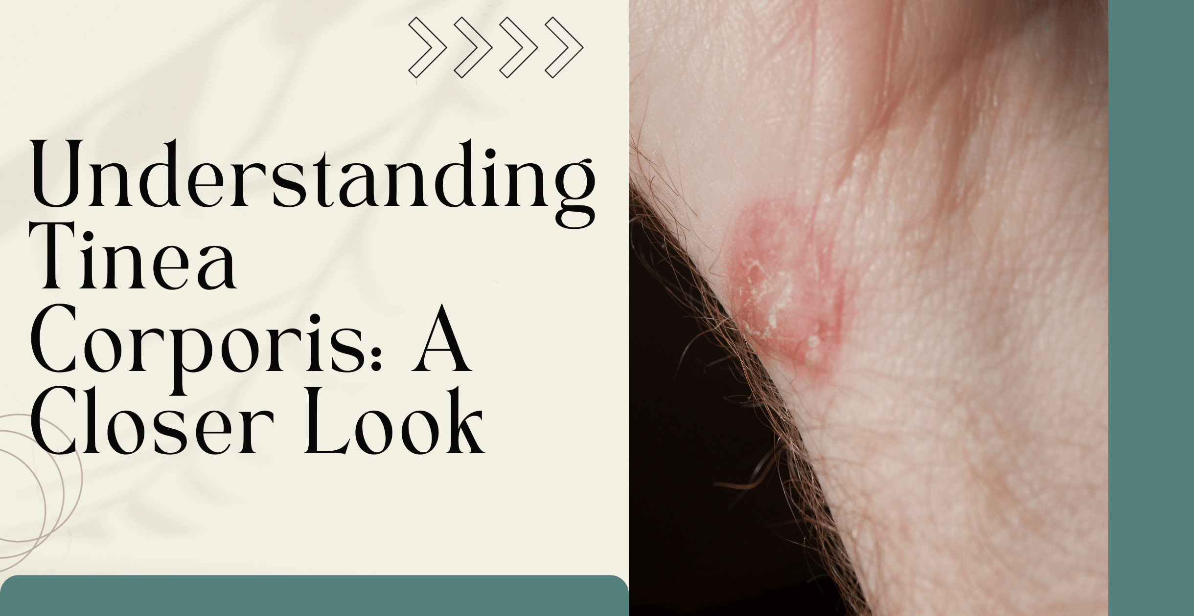 The Secrets of Tinea Corporis and Glowing Skin | Clinikally