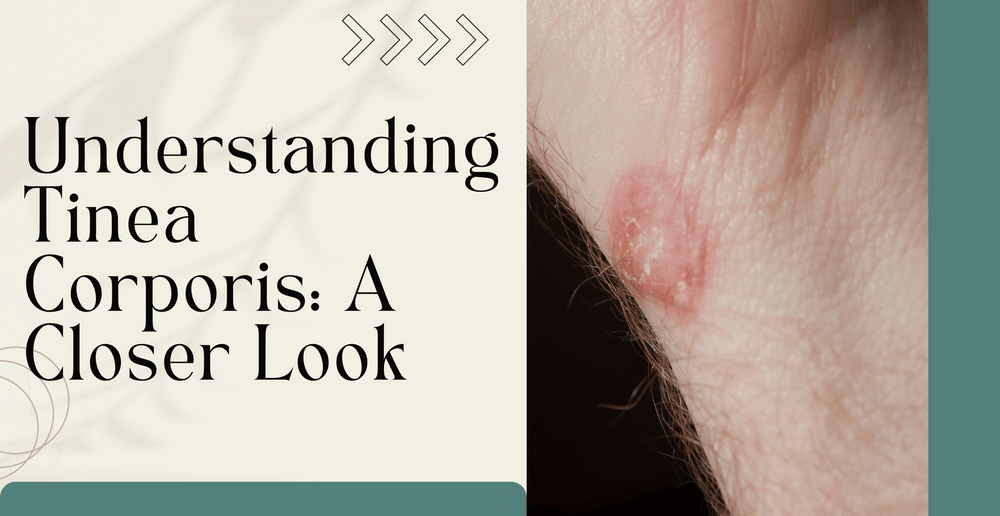 The Secrets of Tinea Corporis and Glowing Skin | Clinikally