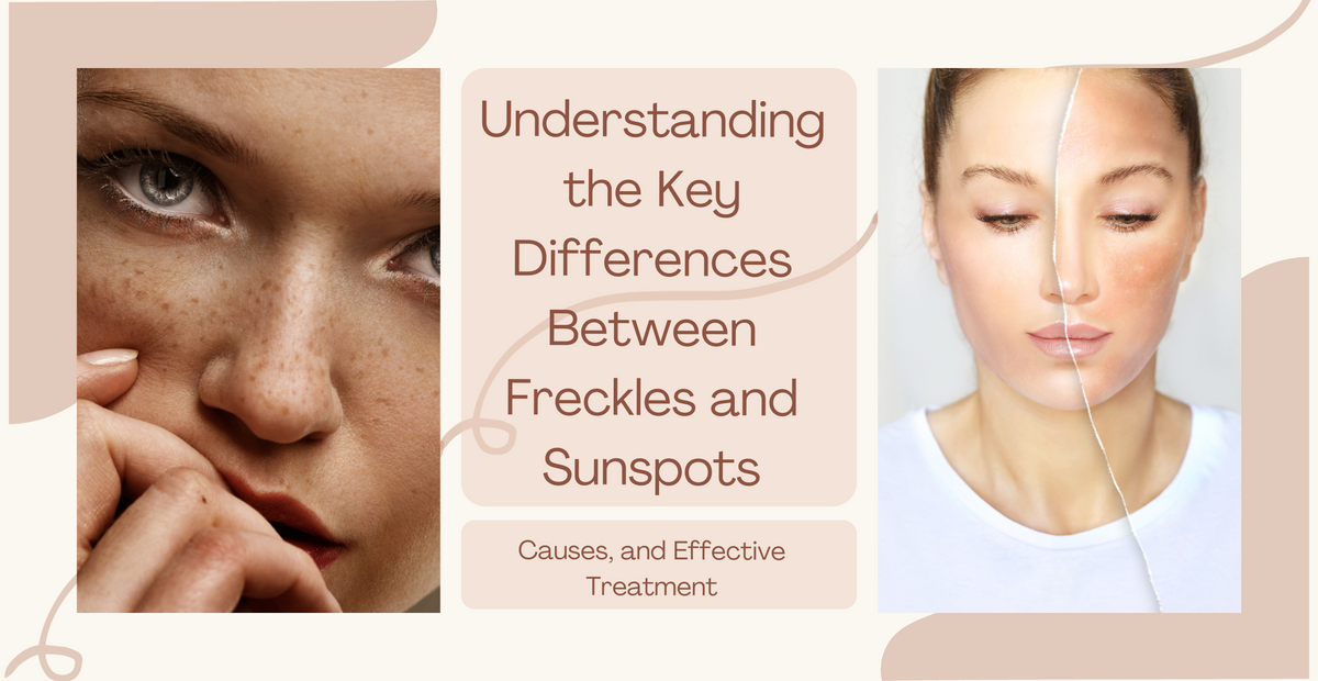Understanding the Key Differences Between Freckles and Sunspots ...