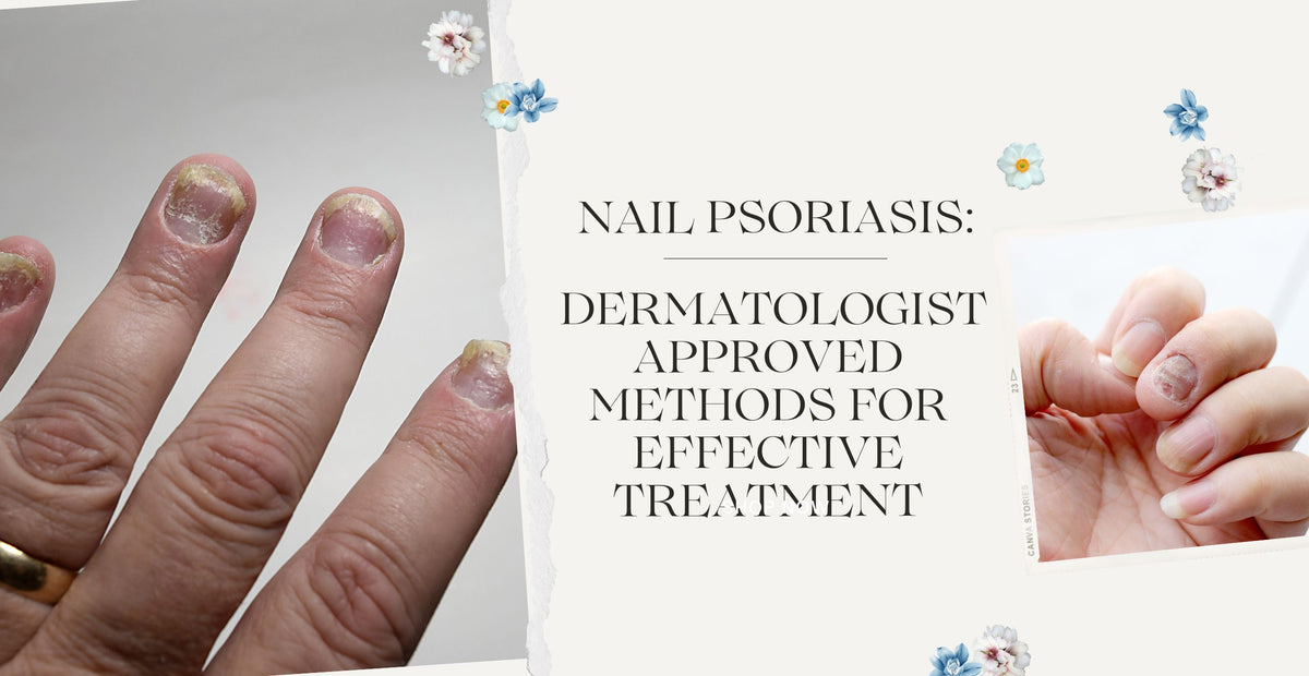 Nail Psoriasis: Dermatologist-Approved Methods for Effective Treatment ...