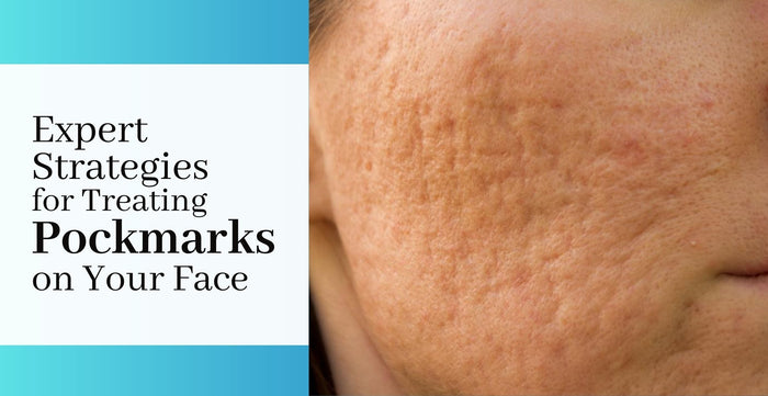 Expert Strategies for Treating Pockmarks on Your Face | Clinikally