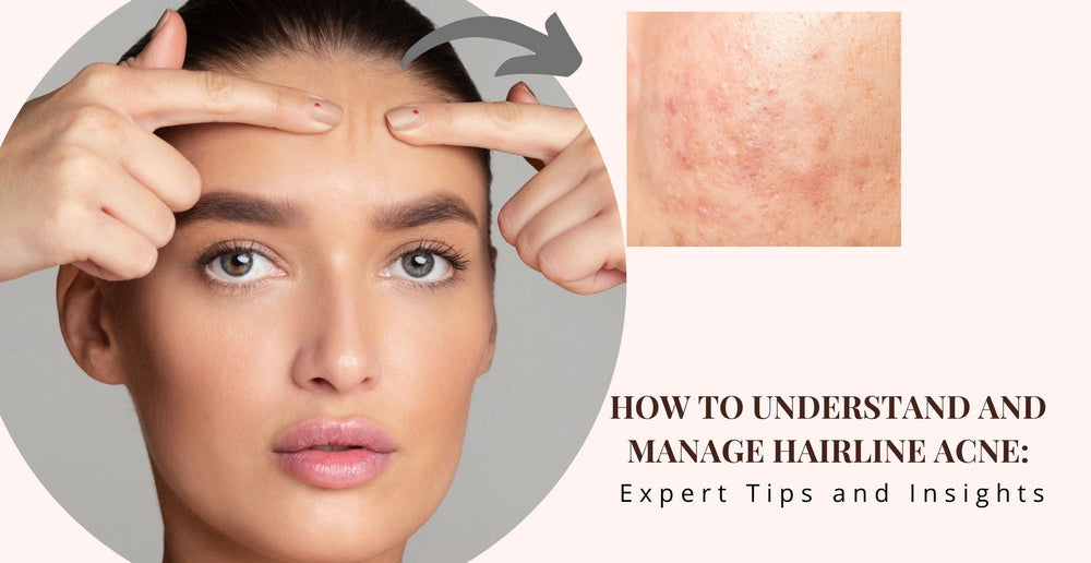 How to Understand and Manage Hairline Acne | Clinikally