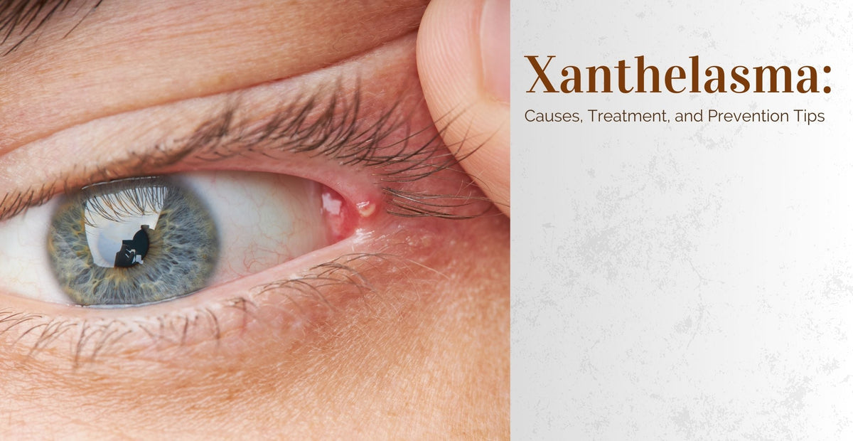 Xanthelasma: Causes, Treatment, and Prevention Tips | Clinikally