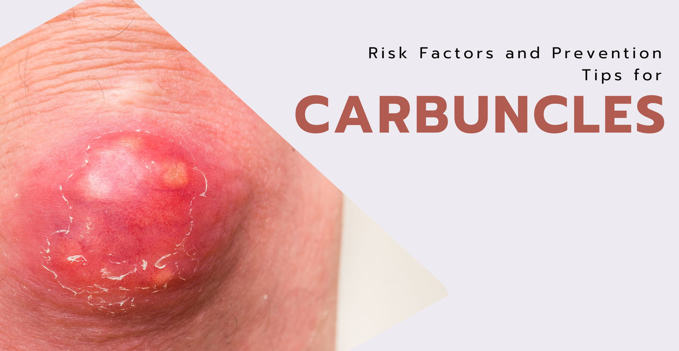 Risk Factors and Prevention Tips for Carbuncles | Clinikally