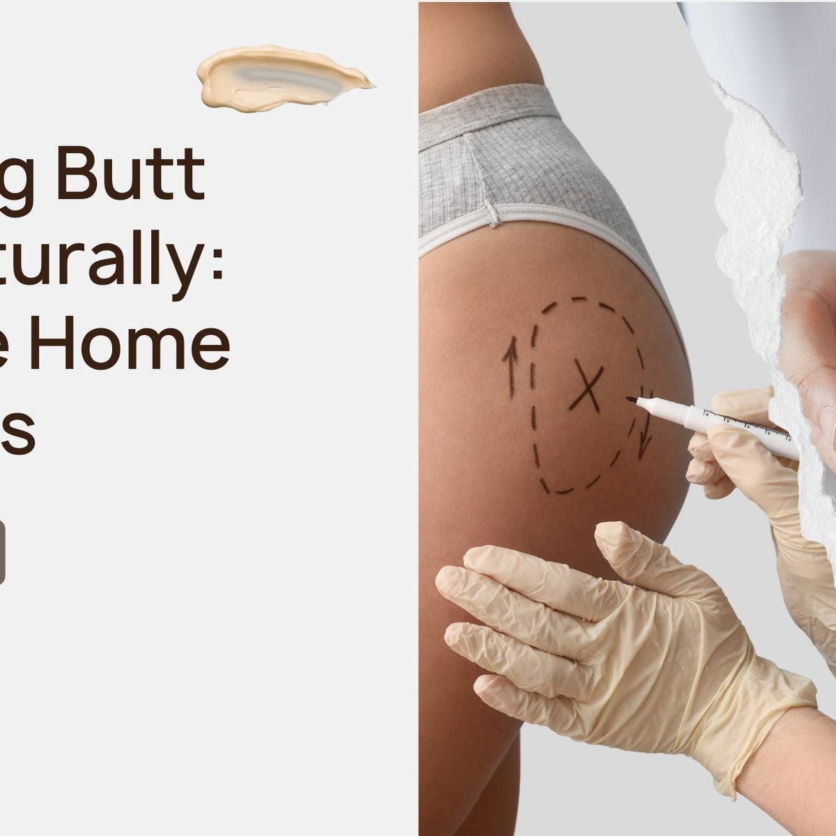 severe pimples on buttocks