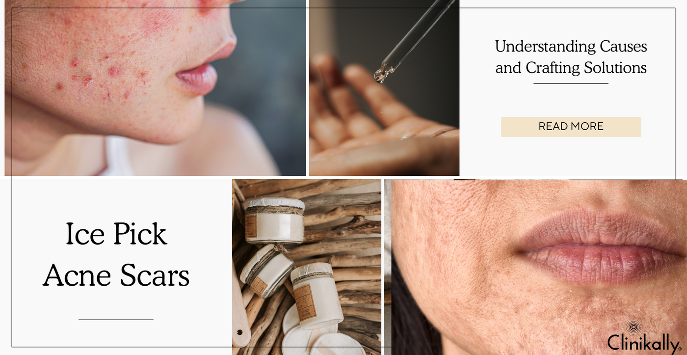 How Can You Treat Ice Pick Scars for a Smoother Complexion