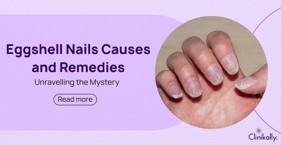 Eggshell Nails Causes & Remedies: Unravelling the Mystery | Clinikally