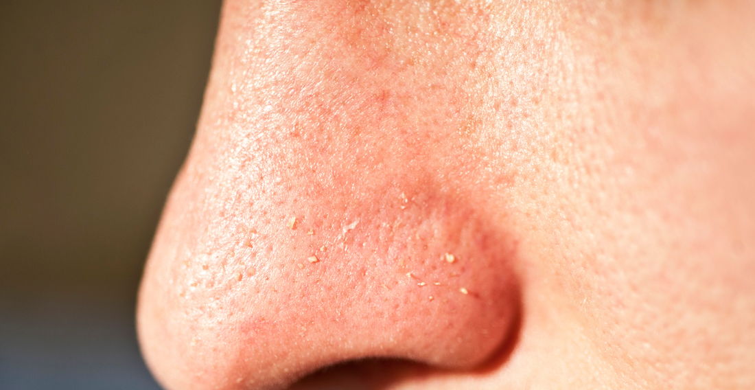 How to Get Rid of Whiteheads | Clinikally