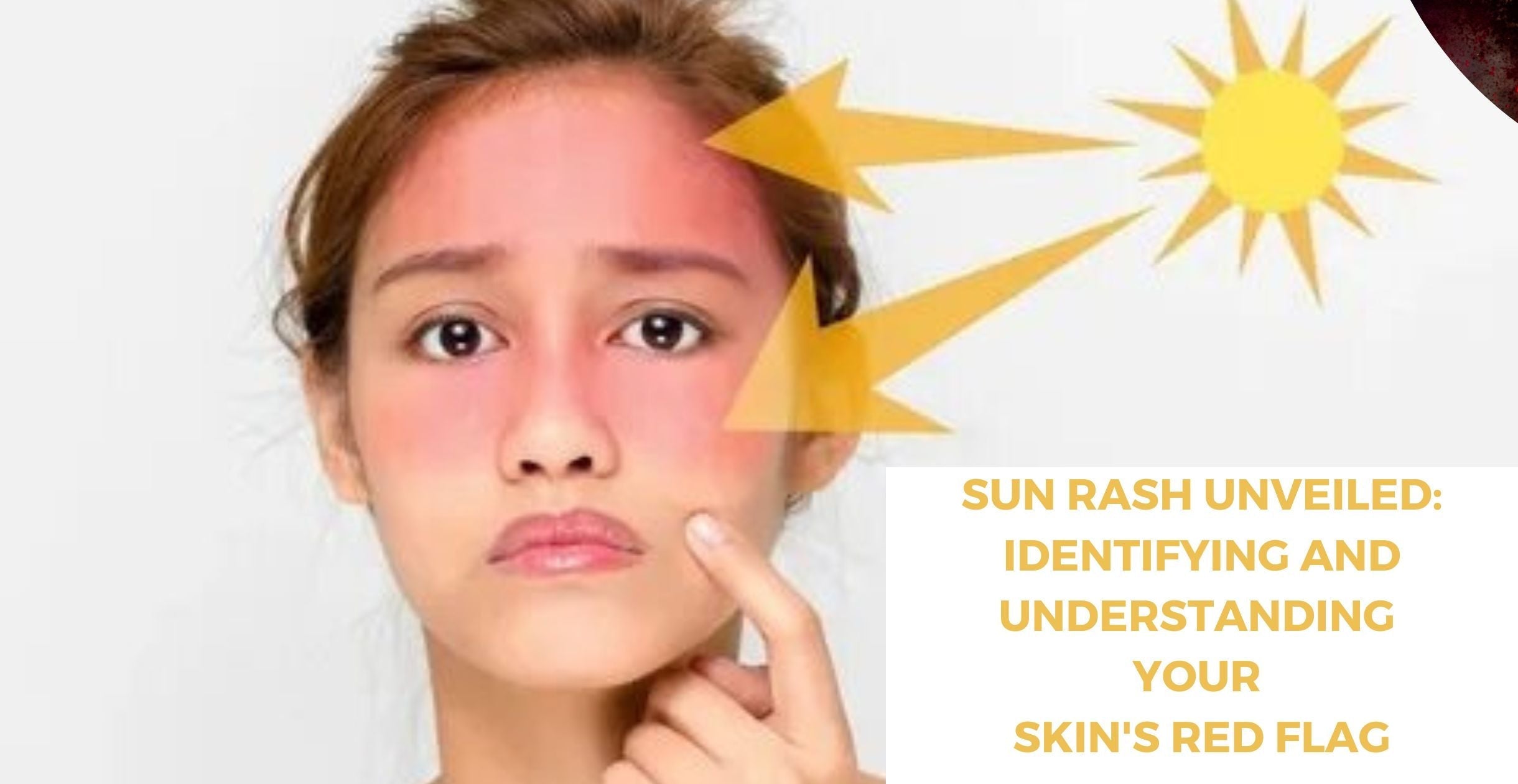 Sun Rash Unveiled: Identifying and Understanding Your Skin's Red Flag ...