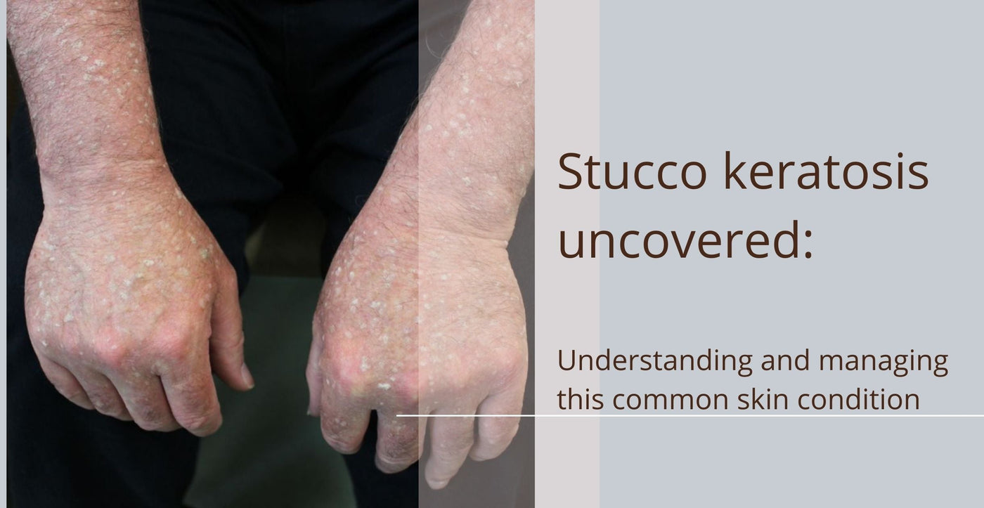 Stucco keratosis uncovered: understanding and managing this common skin ...