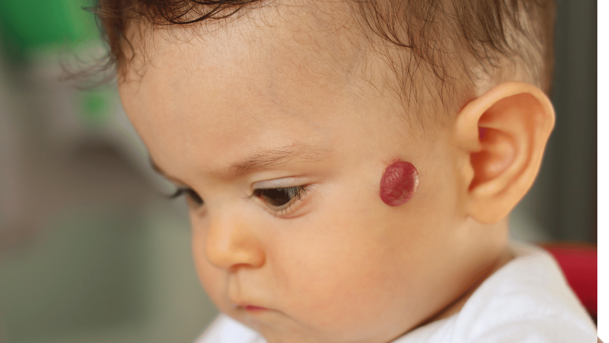 Cavernous Hemangioma Of Skin