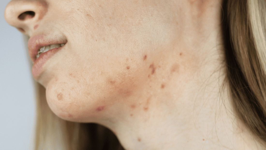 How to Get Rid of Acne on Your Neck: Doctor's Guide | Clinikally