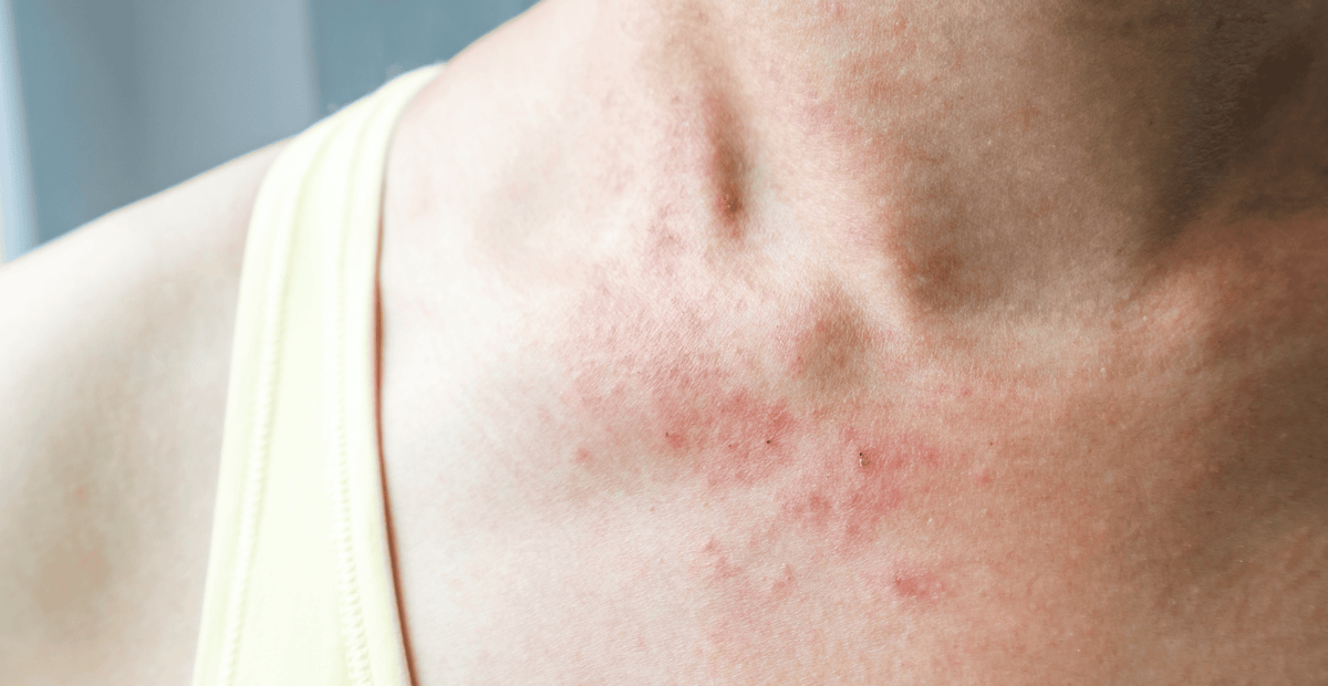Difference Between Rash and Hives? Doctor's Guide | Clinikally