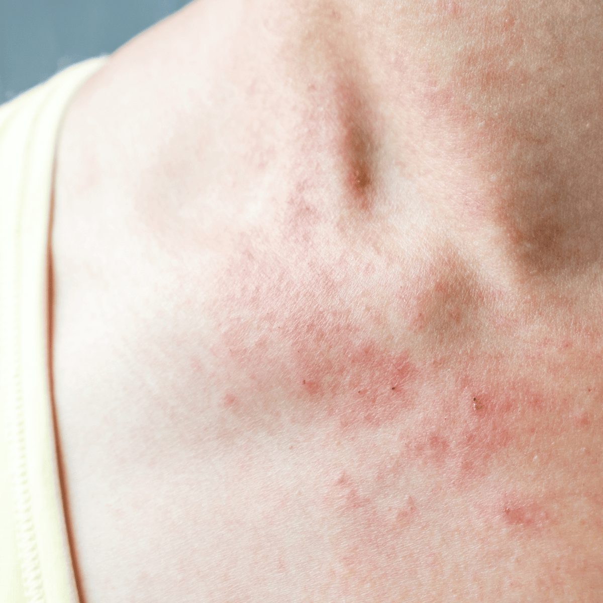 hives on face and neck treatment