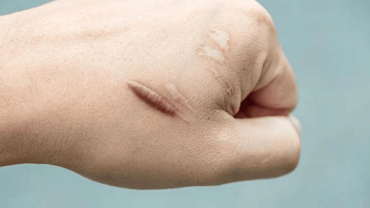 Keloids Scar: Treatment and Effective Home Remedies | Clinikally