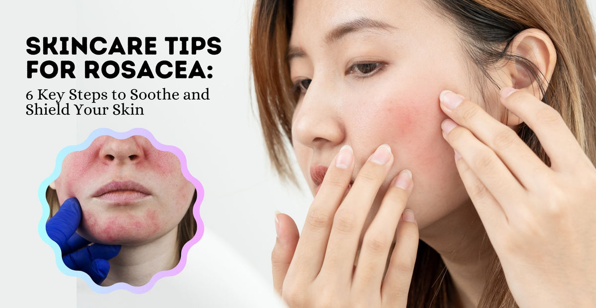 Skincare Tips for Rosacea: 6 Key Steps to Soothe and Shield | Clinikally