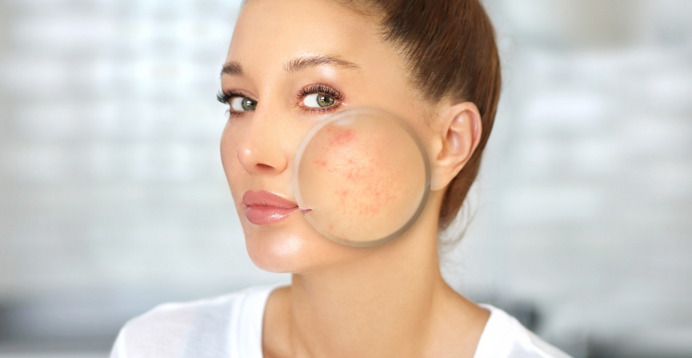 The Truth About Junk Food and Acne | Clinikally