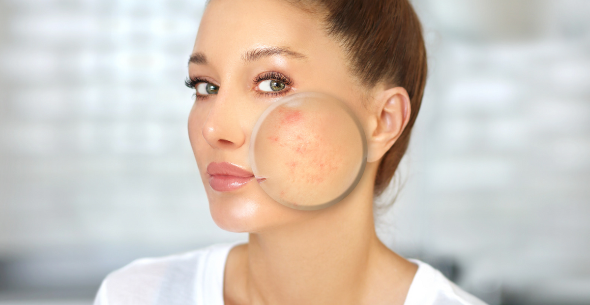 The Truth About Junk Food and Acne | Clinikally