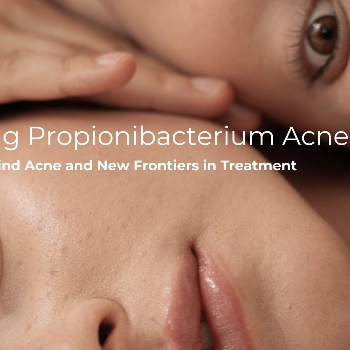 propionibacterium acnes