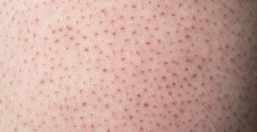 What is Strawberry Skin and How to Treat It? | Clinikally