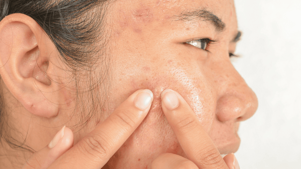 Are Eggs Good or Bad for Acne | Clinikally