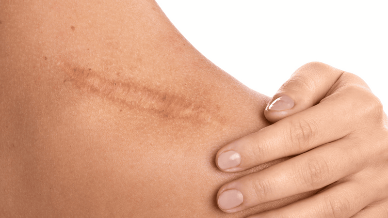 How to treat Atrophic Scars: Doctor's Guide | Clinikally