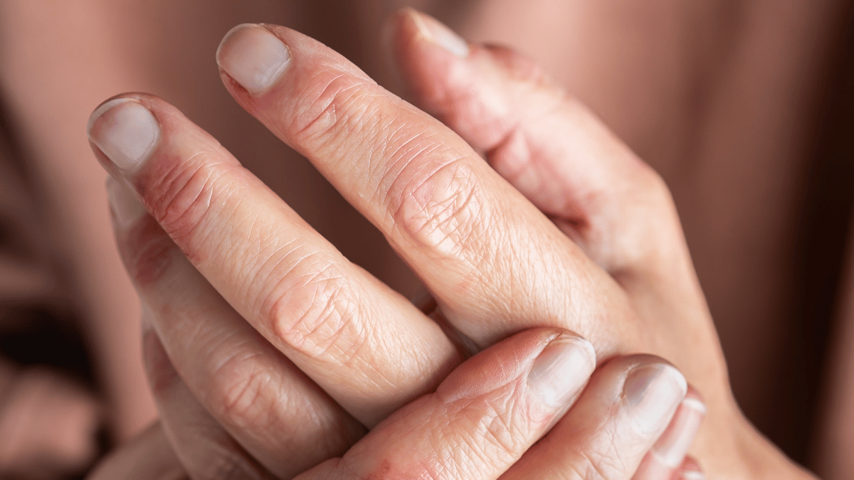 Palmar Erythema(Itchy, Red Palms): Causes & Treatment | Clinikally