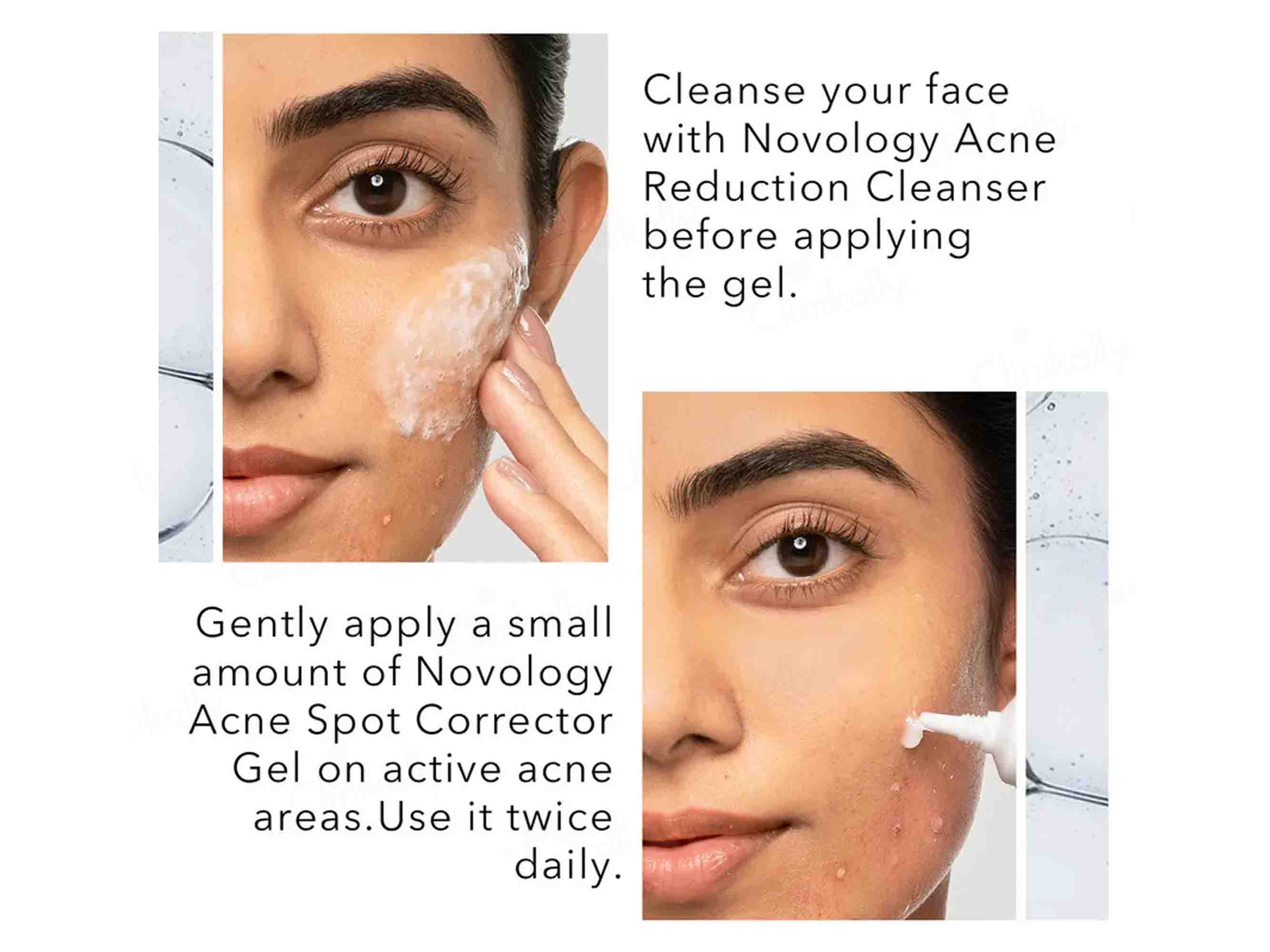 Buy Novology Acne Spot Corrector Gel Online | Clinikally